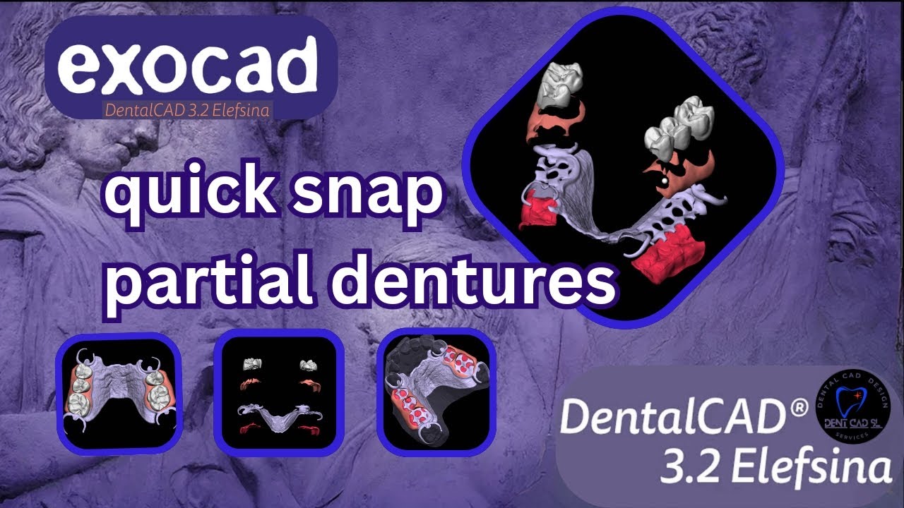 Exocad quick snap partial dentures tutorial elefsina mp4