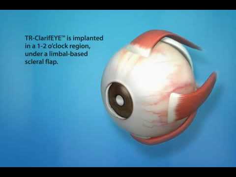 Dog Glaucoma New Treatment for Glaucoma in Dogs