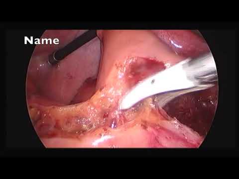 Laparoscopic Right Hemicolectomy for IC junction Koch's