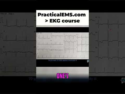 LVH Explained: Diagnosing Left Ventricular Hypertrophy on ECG