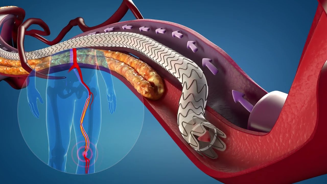 PTAB using the DETOUR System Procedure Animation_MM2589 US Rev 03