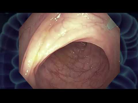 Colonoscopy Jerry Dixon, MD