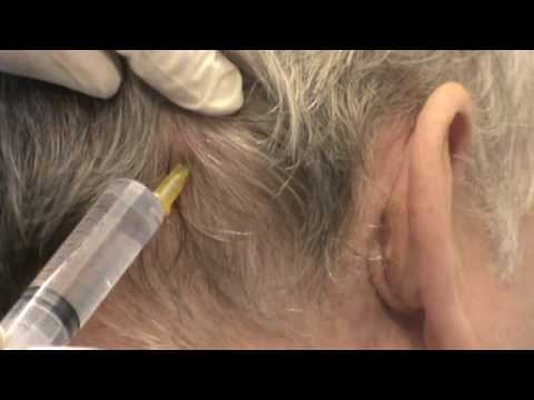Infiltration du nerf grand occipital – Greater occipital nerve ...