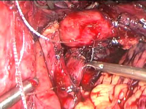 Laparoscopic Revision of Roux-en-Y Gastric Bypass and Hiatal Hernia Repair
