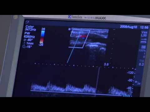 A Carotid Artery Screening - using ultrasound to detect your risk for a stroke.