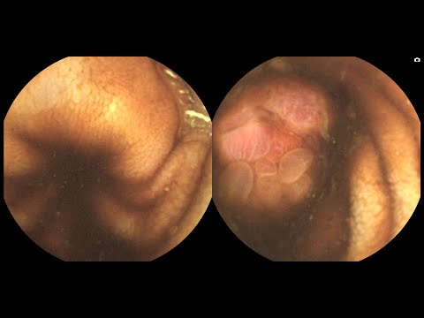MiroCam MC2000 Double Headed Capsule Endoscopy Polypoid Distal Lesion, right side only