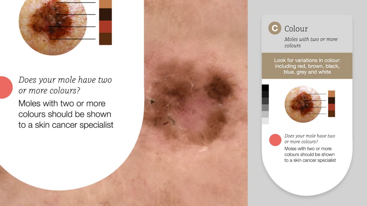 MoleMap Skin Check Tool Tutorial