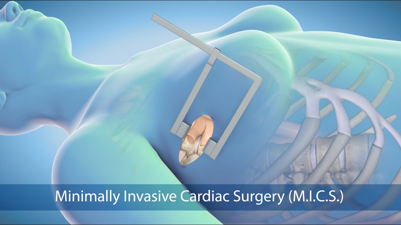 Medical Animation: Minimally Invasive Cardiac Surgery (MICS) at Sarasota Memorial Hospital