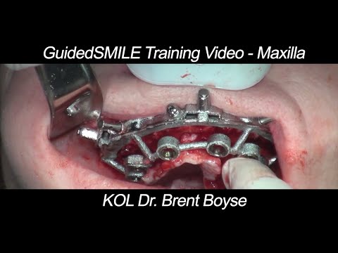 CHROME Dr. Brent Boyse - AO Fast Motion Surgery
