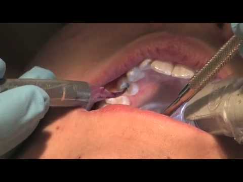 Sealants for Children