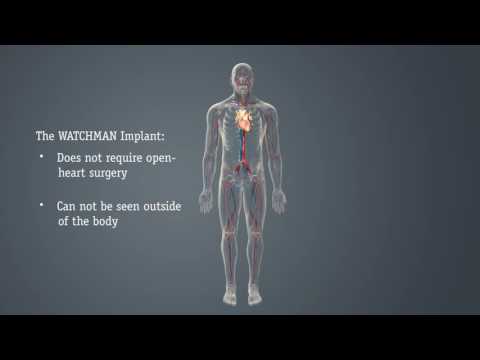Cardiovascular WATCHMANâ„¢ to Reduce AFib Stroke Risk