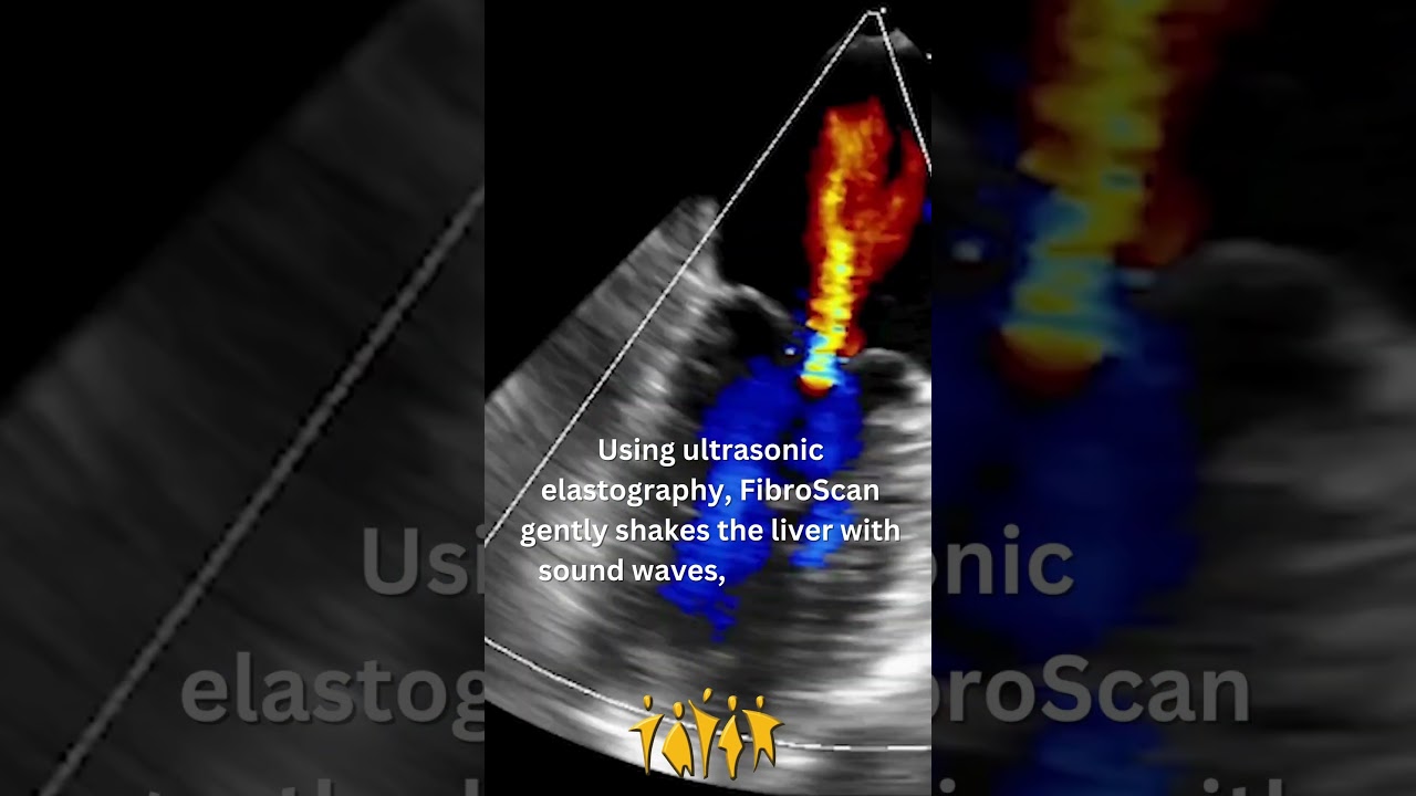 Meet the FibroScan