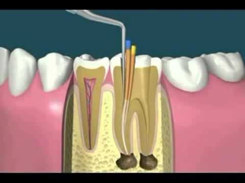 RCT + Crown Animation - Tijuana Dentist