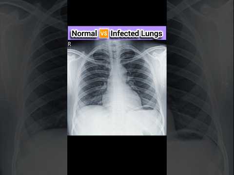 Normal ???? Infected Lungs#gamcamedical