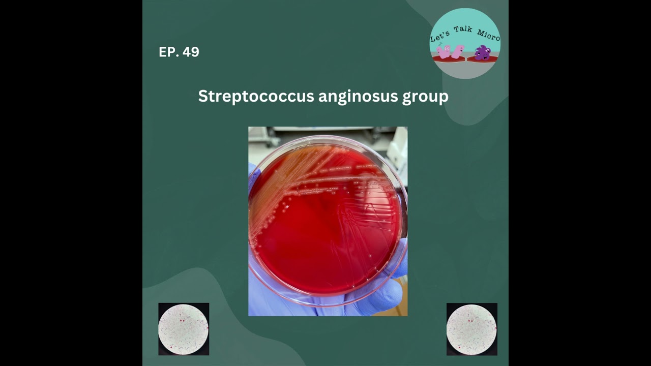 TBT: Streptococcus anginosus group