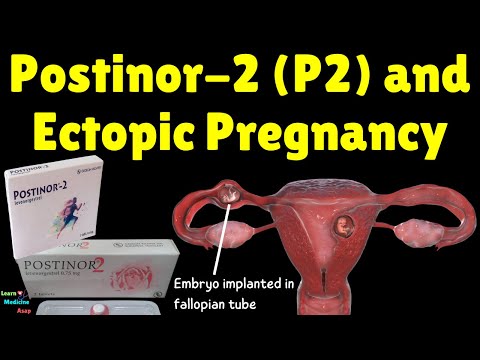 Postinor-2 (P2) and Ectopic Pregnancy | The Link Between Ectopic Pregnancy & Emergency Contraceptive
