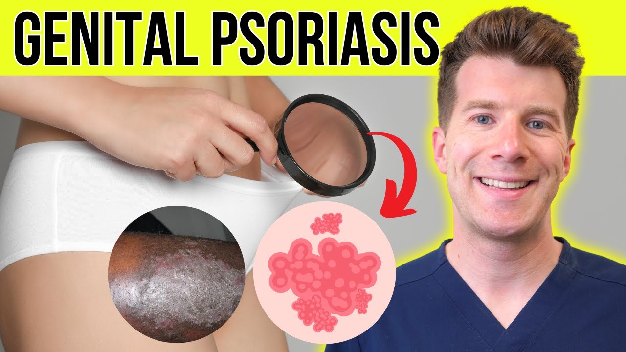 Doctor explains GENITAL PSORIASIS | Causes, symptoms and TREATMENT