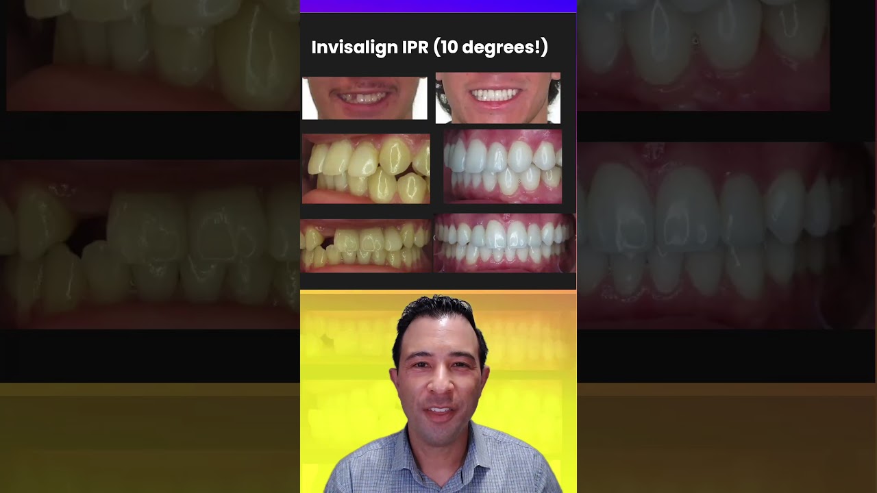 Fix Forward/Backward Front Teeth: Invisalign vs Braces by Expert Invisalign Orthodontist #Invisalign