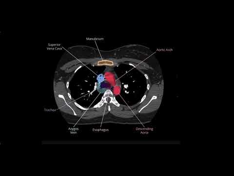 Chest Anatomy on actual CT Scan Simplified with Labels | Radiology Illustration
