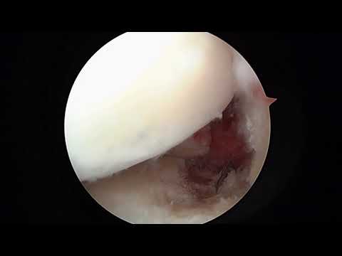 L Knee Medial Meniscus Root Tear Repair 6 15 20 AF