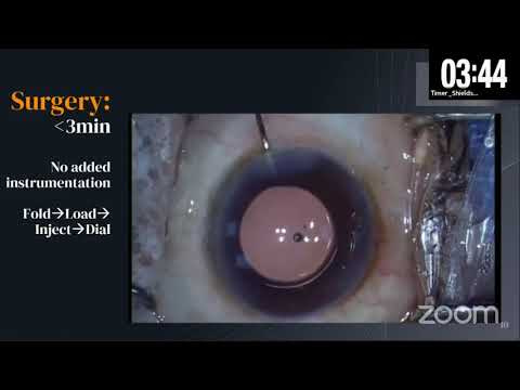 Phaco Training: Dr. Roop presents Managing Negative Dysphotopsia ...