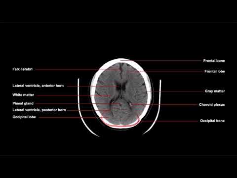 Recognizing anatomy on an axial CT scan of the brain: Cross-sectional anatomy made easy