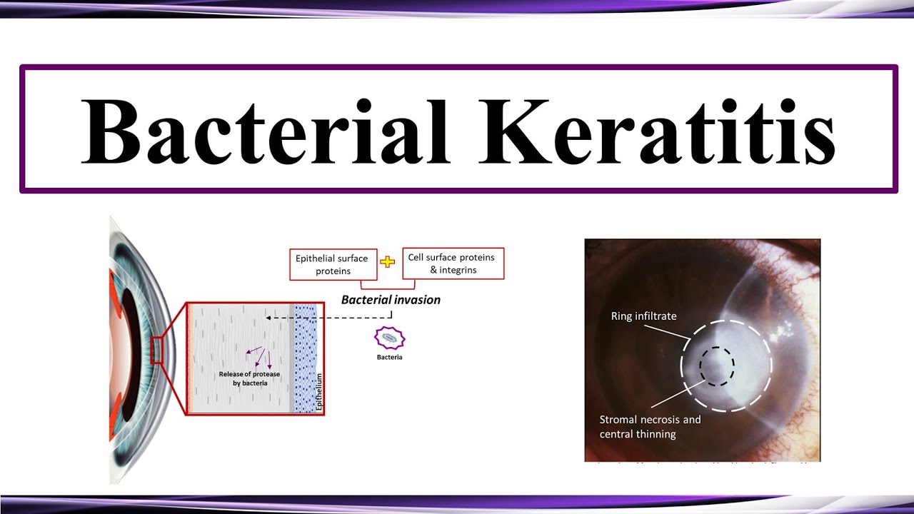 Bacterial Keratitis