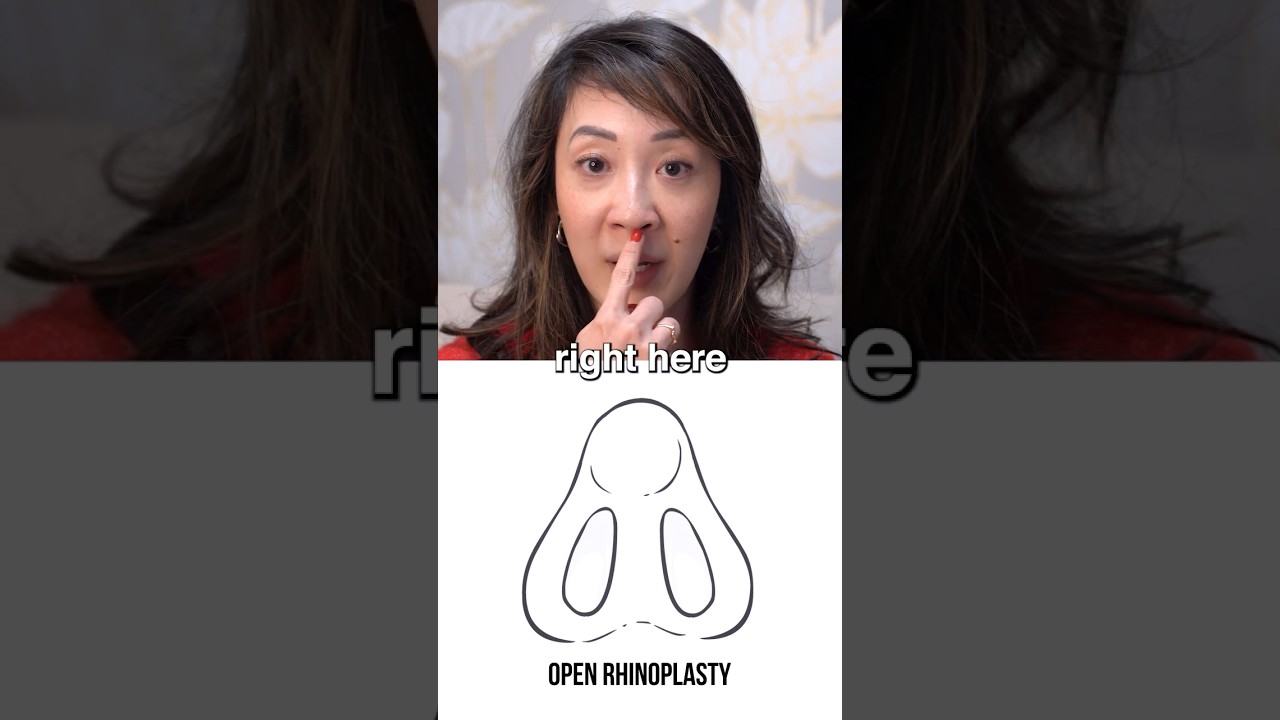 Open vs. Closed Rhinoplasty: What’s the Difference? - Face the Facts with Dr. Lexie Wang