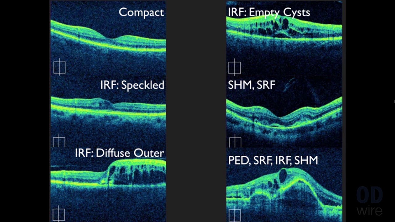 Macular OCT Interpretation: A Practical Discussion with Dr. David E. Lederer