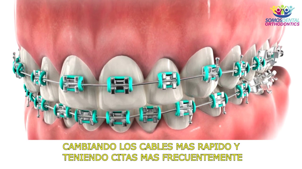 Somos Dental Tips:  Fast Pass Program