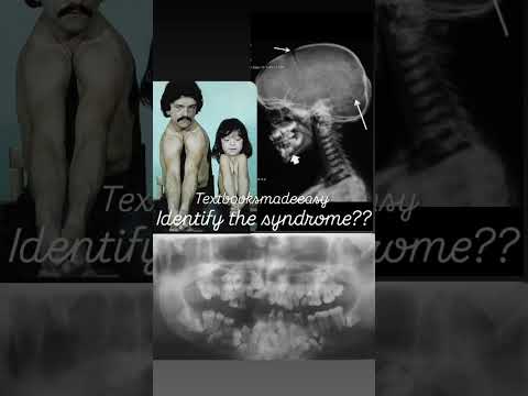 #syndromes #medicalofficer #dental #dentist #medical #neet