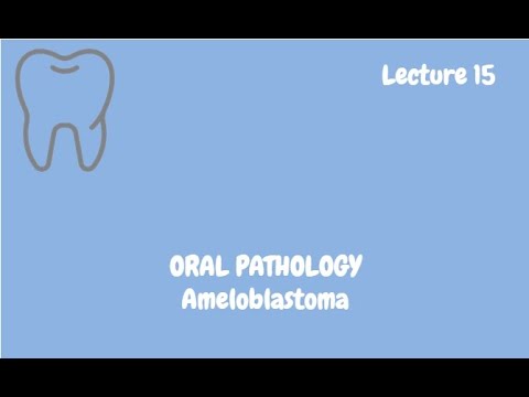 Ameloblastoma (Complete Lecture) | For NBDE, NDEB, MDS & FCPS