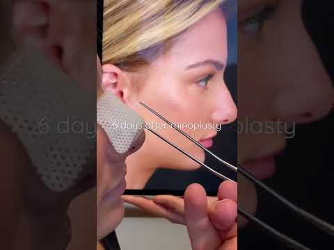 Splint removal 6 days after rhinoplasty