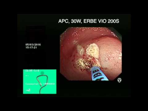 Saline assisted APC to treat caecal angiodysplasia