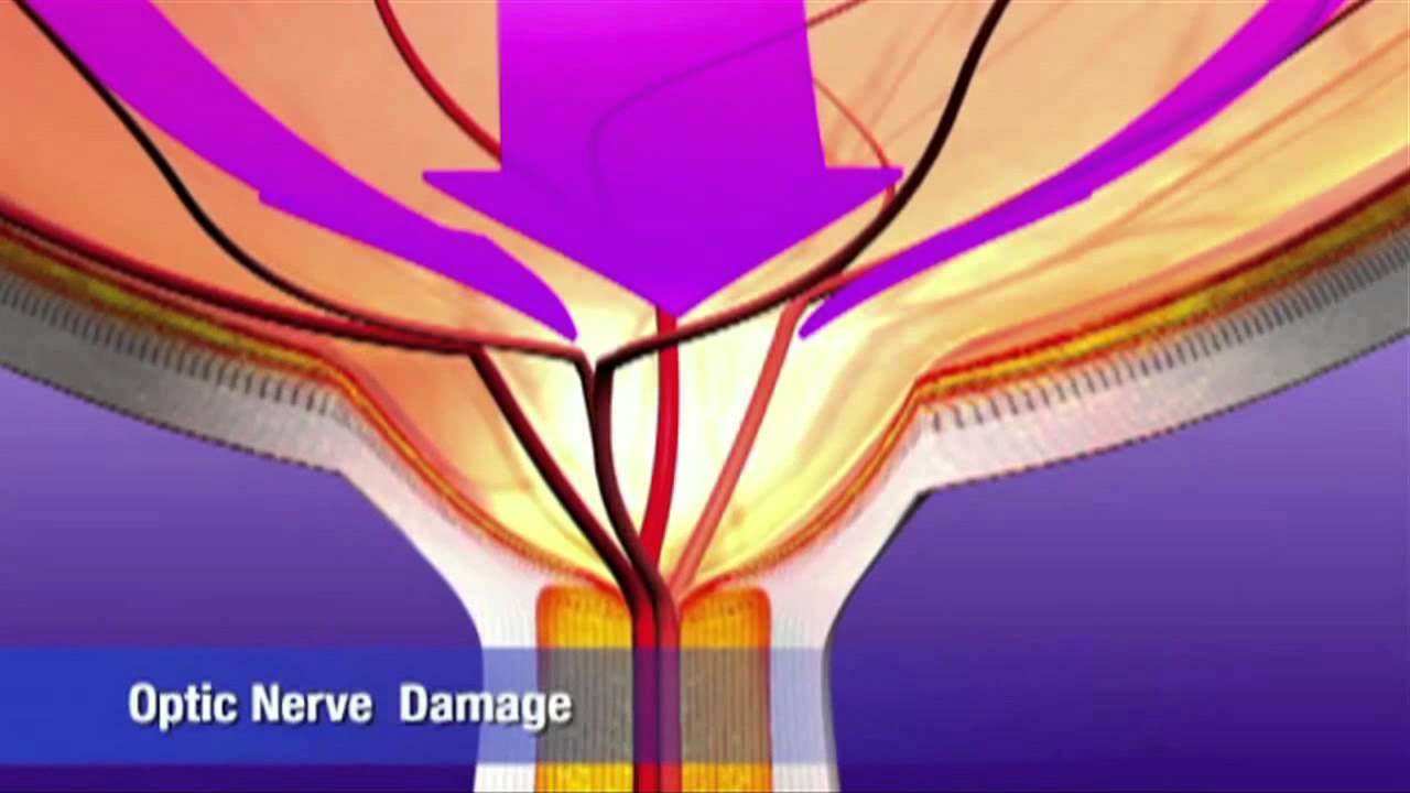Trabectome Animation (1:29 min)