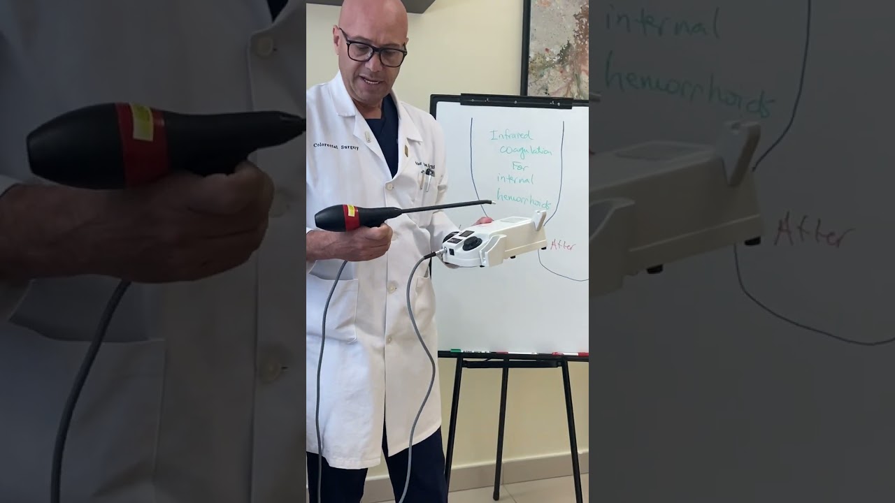 Best office based non-surgical treatment of piles (internal hemorrhoids):  infrared coagulation
