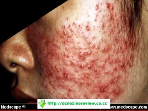 Go through This First Prior to You Purchase Acnezine | Acnezine - pimples