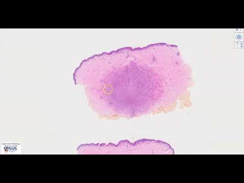 Skin: Dermatofibroma Microscopy (Talking slide)