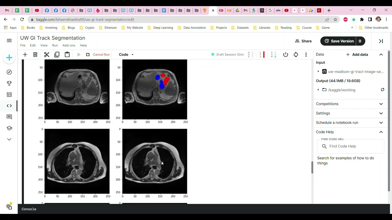 UW Madison GI Tract Image Segmentation Competition on Kaggle Using Deep Learning Model