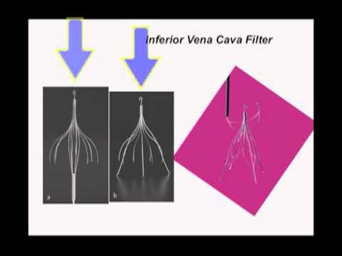 UCSF Radiology: Interventional Radiology and Deep Vein Thrombosis