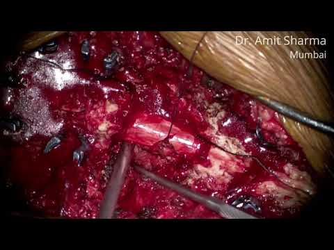 Vertebral Column Resection (Thoracic Metastasis)