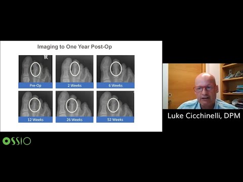 OSSIOfiber First-In-Human Clinical Study Summary with Luke Cicchinelli, DPM
