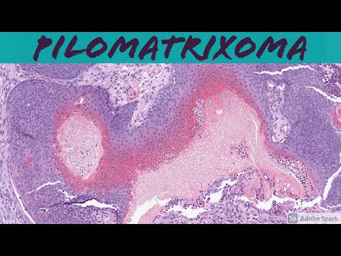 Pilomatrixoma...with lots of blue basaloid cells (and mitoses!)