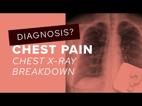 Chest X-Ray breakdown: assessing multiple lung nodules