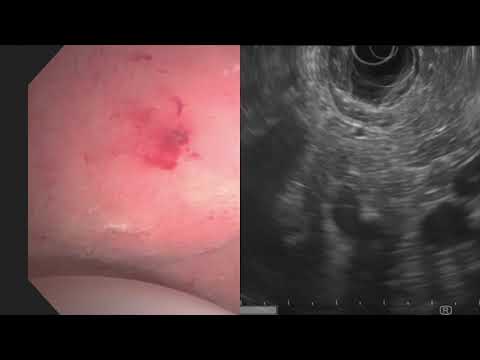Importance of water insufflation in the EUS