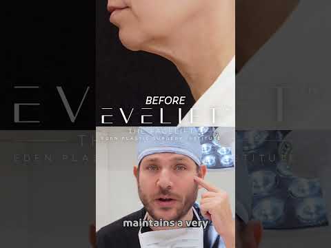 EVE Lift™ Before And After With Dr. Charafeddine | Eden Plastic Surgery | Miami Facelift Surgeon