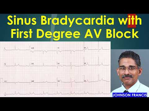 Sinus Bradycardia with First Degree AV Block