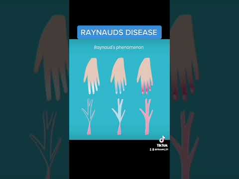 Raynaud’s disease