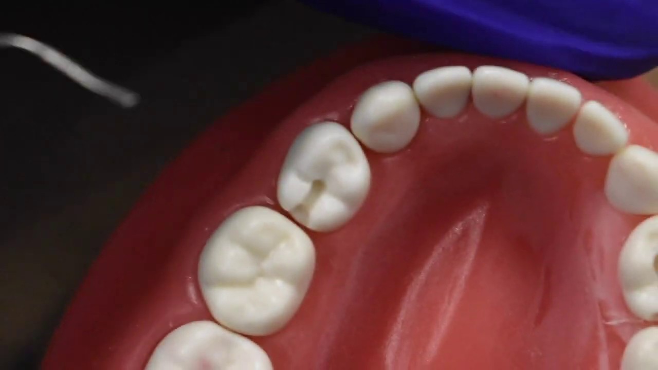 Class 2 Preparation for Primary Tooth