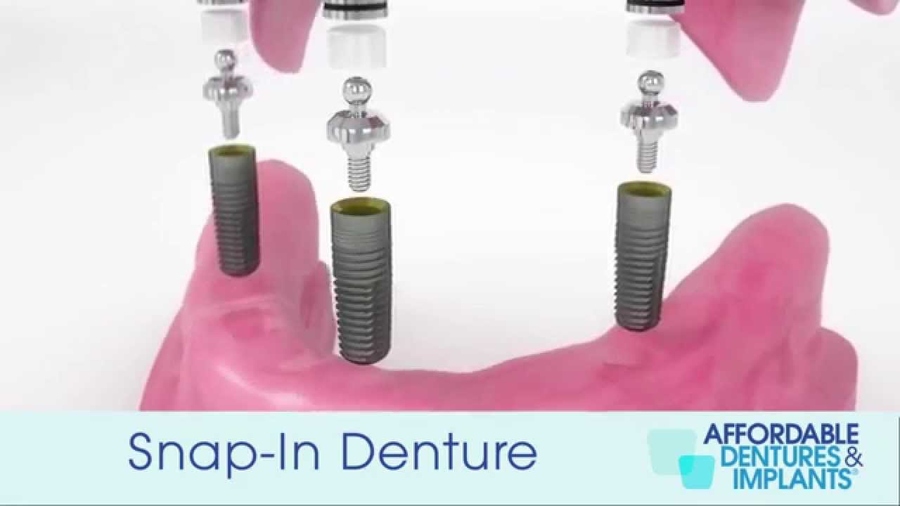 Demo: How Do Snap-In Dentures With Implants Work?